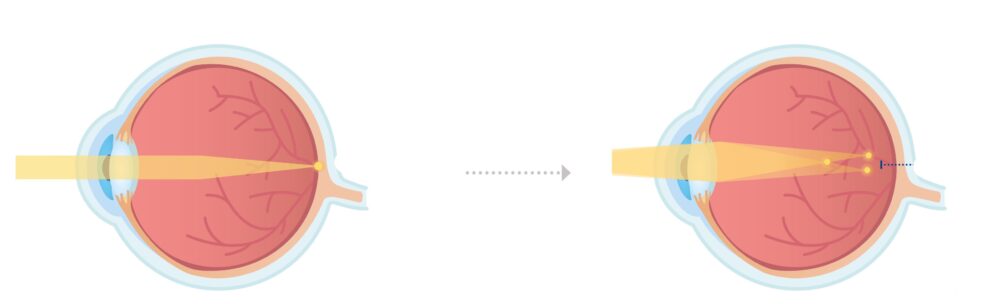 Visione Distorta: Quali Sono le Cause? - Blog di Clinica Baviera Italia