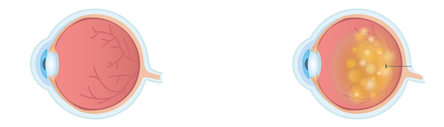 Visione Distorta: Quali Sono le Cause? - Blog di Clinica Baviera Italia