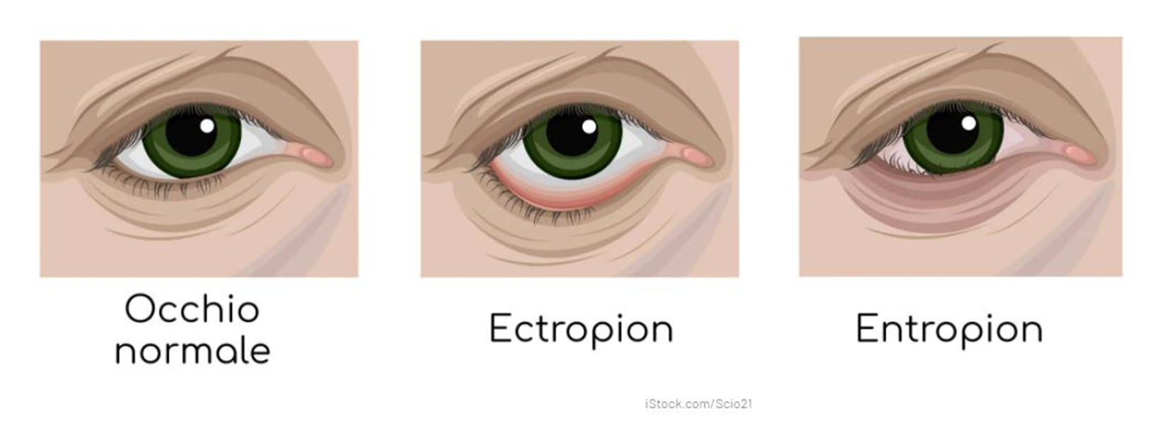 Ectropion Occhio: cause, sintomi e cura - Blog di Clinica Baviera Italia