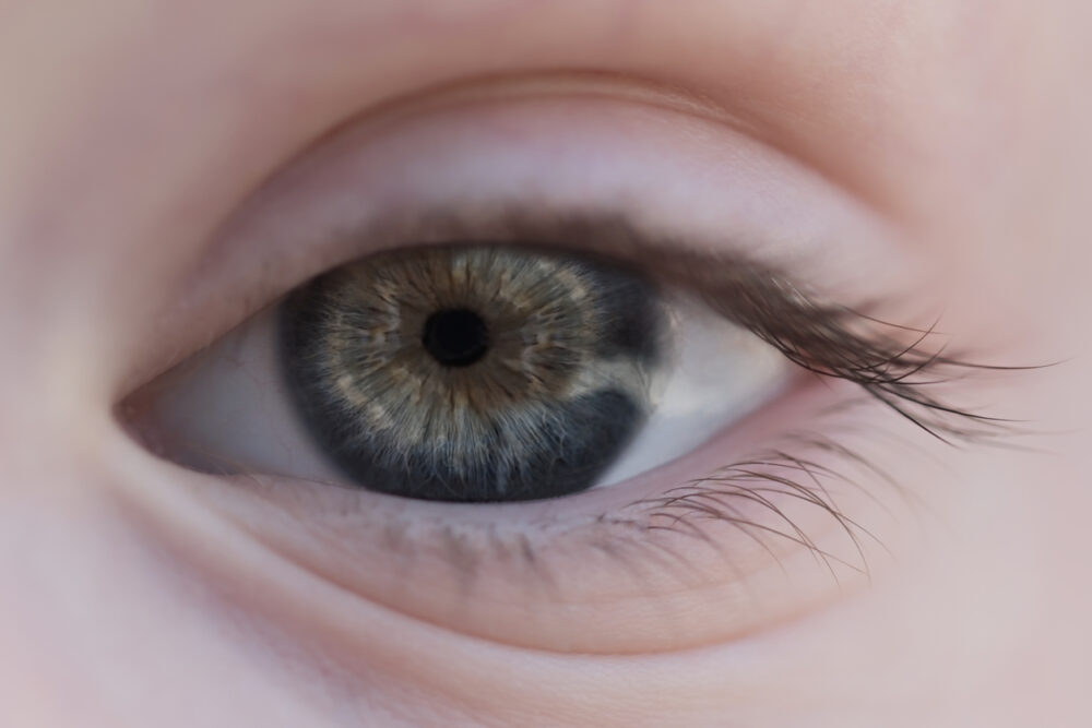 Gerontoxon o arco senile: cos'è e come si cura- Blog di Clinica Baviera ...