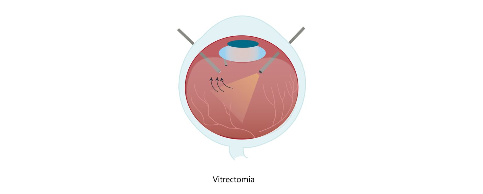Vitrectomia: cos’è e in cosa consiste l'intervento?- Blog di Clinica ...