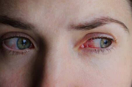 Iperemia congiuntivale: cause e sintomi - Blog di Clinica Baviera Italia