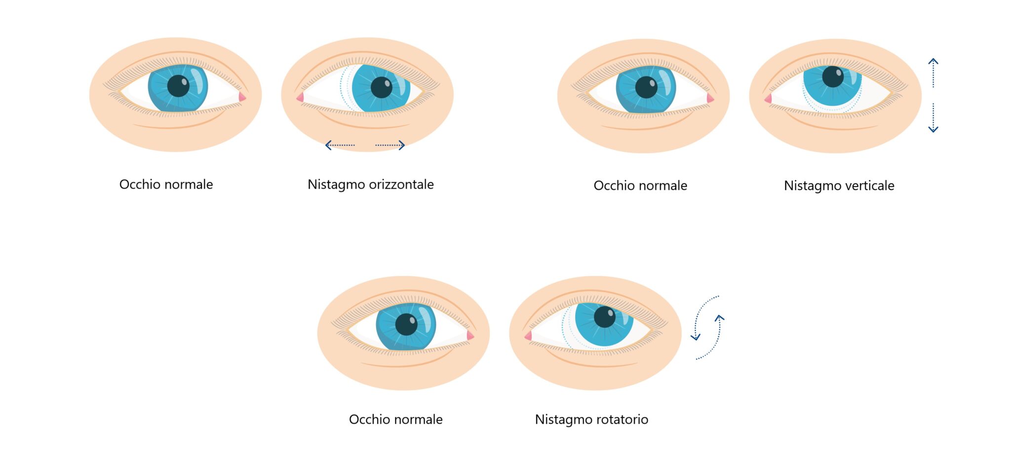 Nistagmo oculare: cos’è e come si cura? - Blog di Clinica Baviera