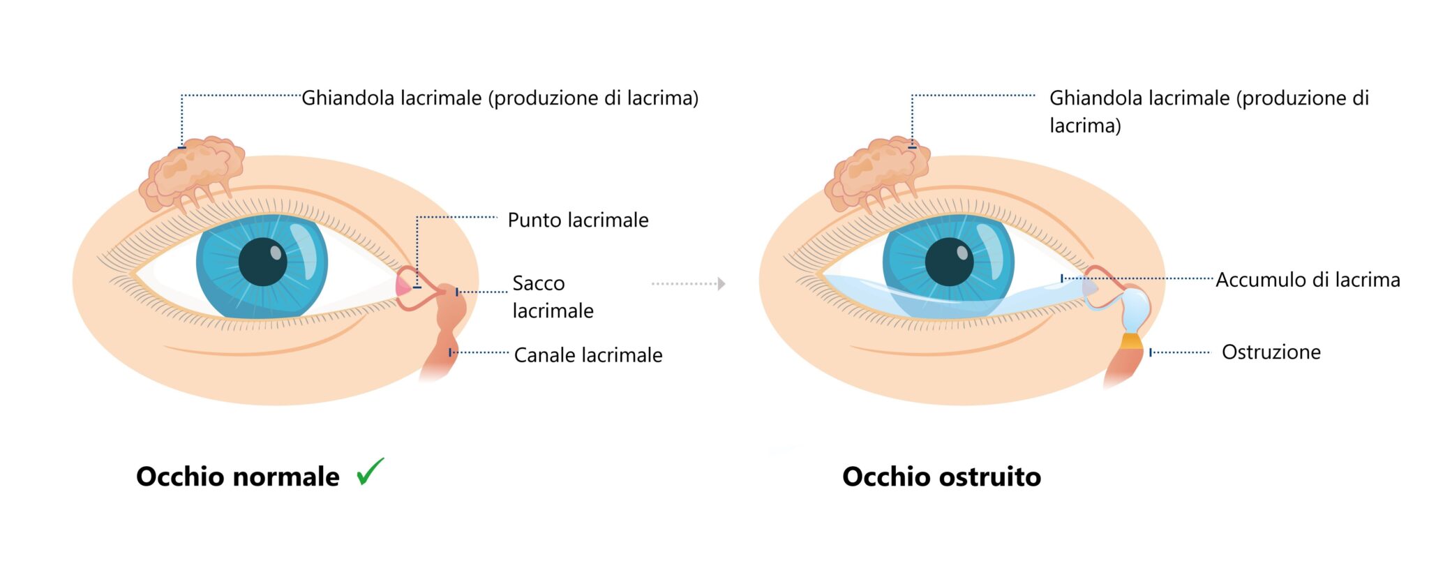 Dacriocistite: tipi, cause, sintomi e cura - Blog di Clinica Baviera Italia