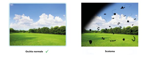 Scotoma che cos’è? - Blog di Clinica Baviera Italia