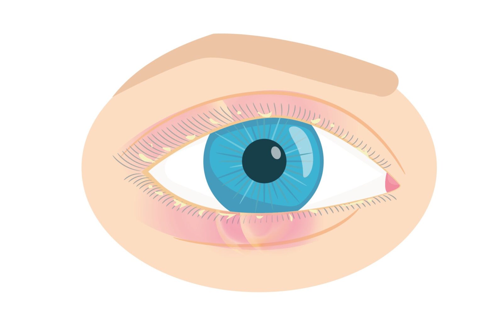 Dermatite Palpebrale: cos'è e come si cura? - Blog di Clinica Baviera ...
