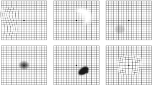 Degenerazione Maculare: cos'è, sintomi, cura - Blog di Clinica Baviera ...