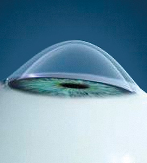 Cheratocono occhio: cos'è, cause, come si cura | Clinica Baviera